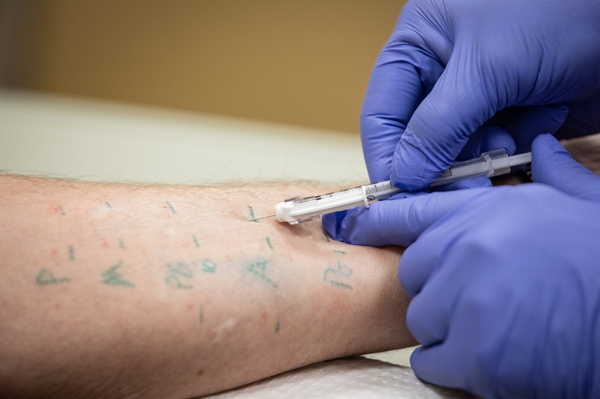 Clinic marks 10th year of diagnosis and treatment of drug allergies ...