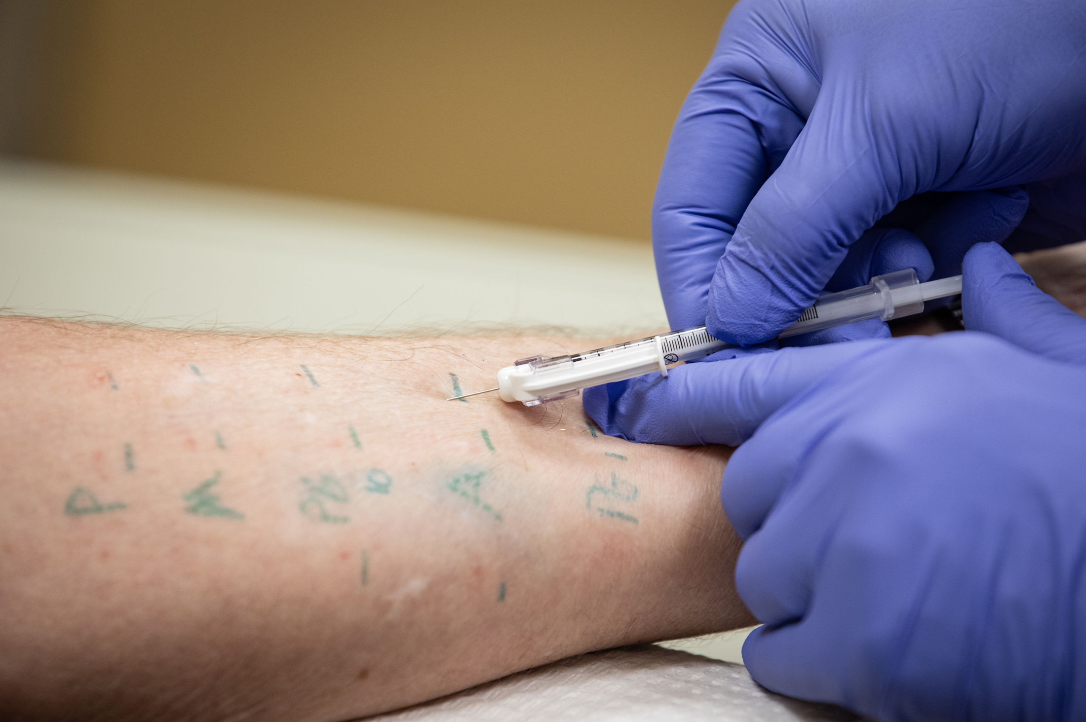 Clinic marks 10th year of diagnosis and treatment of drug allergies ...