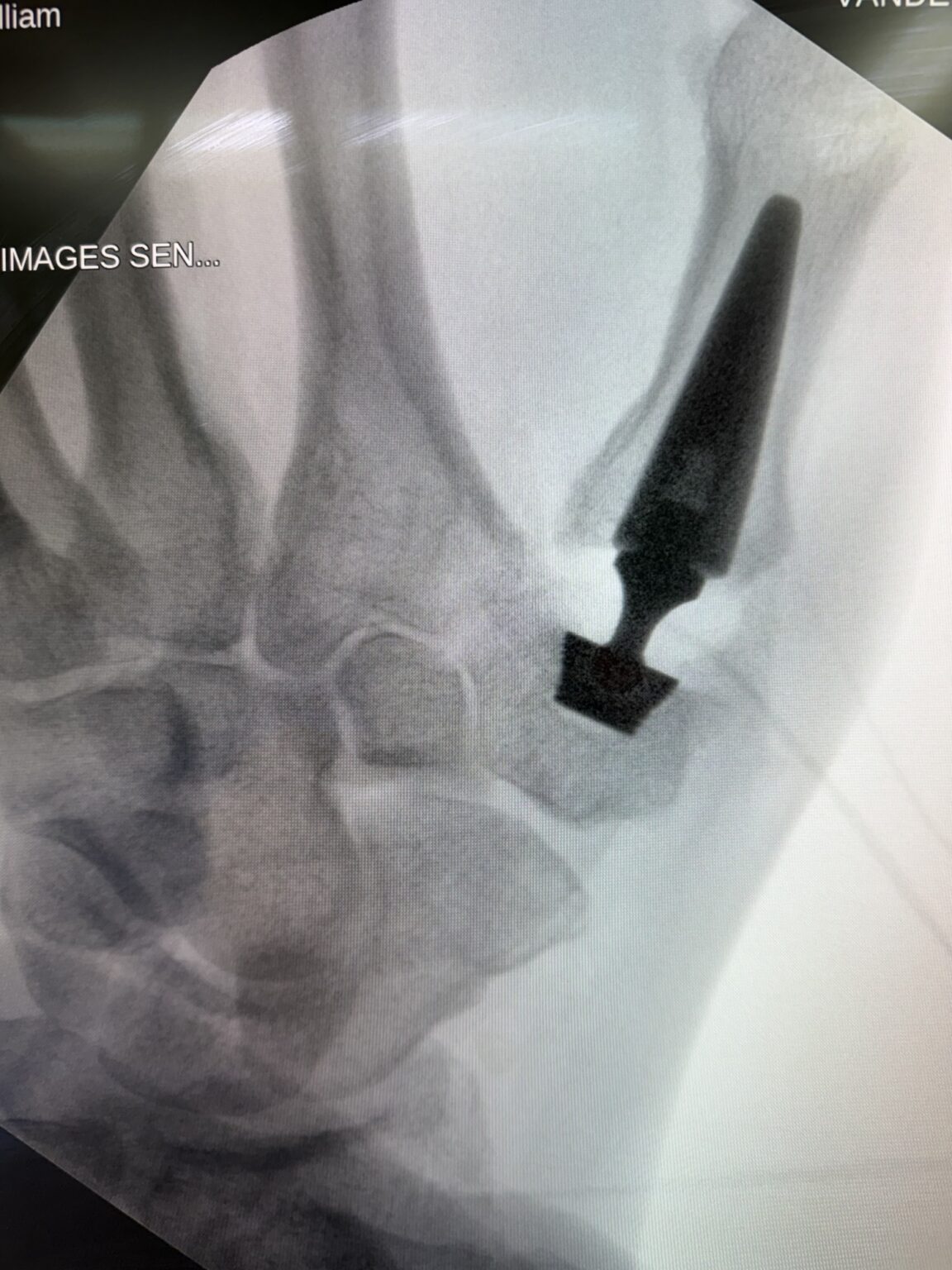 New surgery for thumb arthritis offered at Vanderbilt Health ...