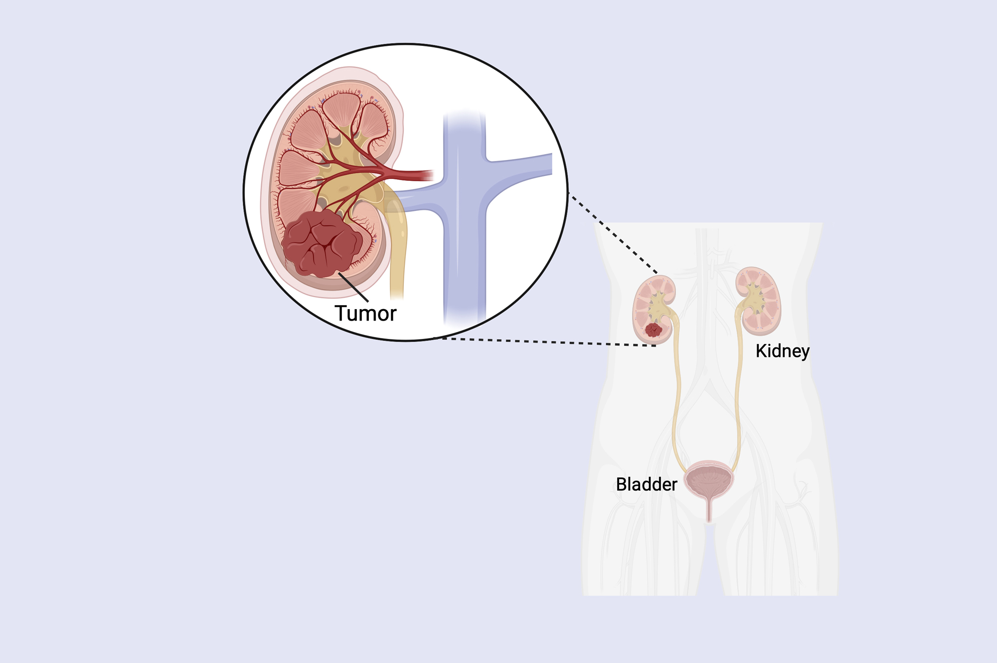 Study reveals potential new way to stop a common kidney cancer - VUMC News