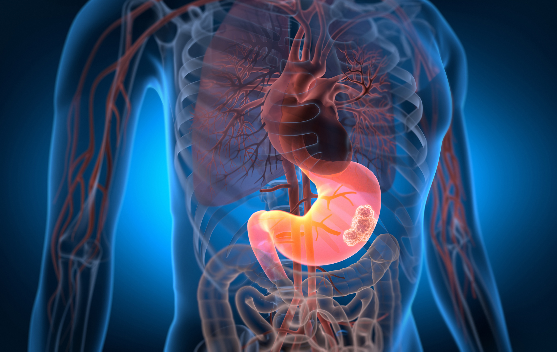 Drug shows safety, efficacy for precancerous stomach lesions ...