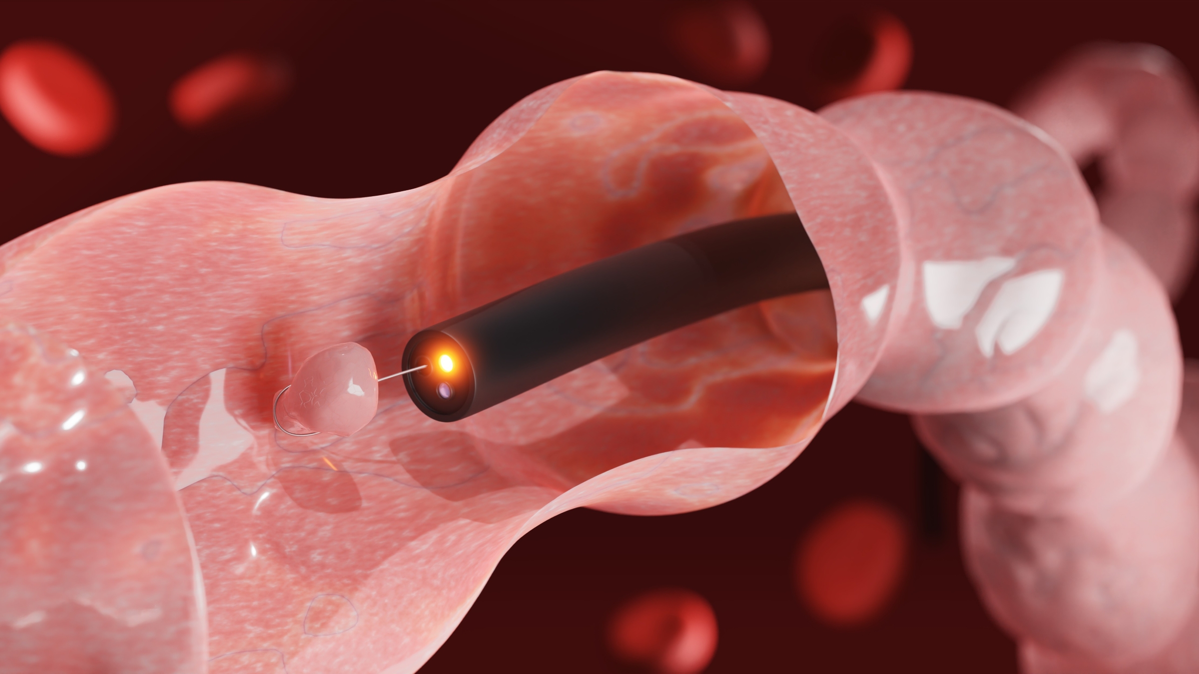Demographic and histologic factors influence risk of colon polyp ...