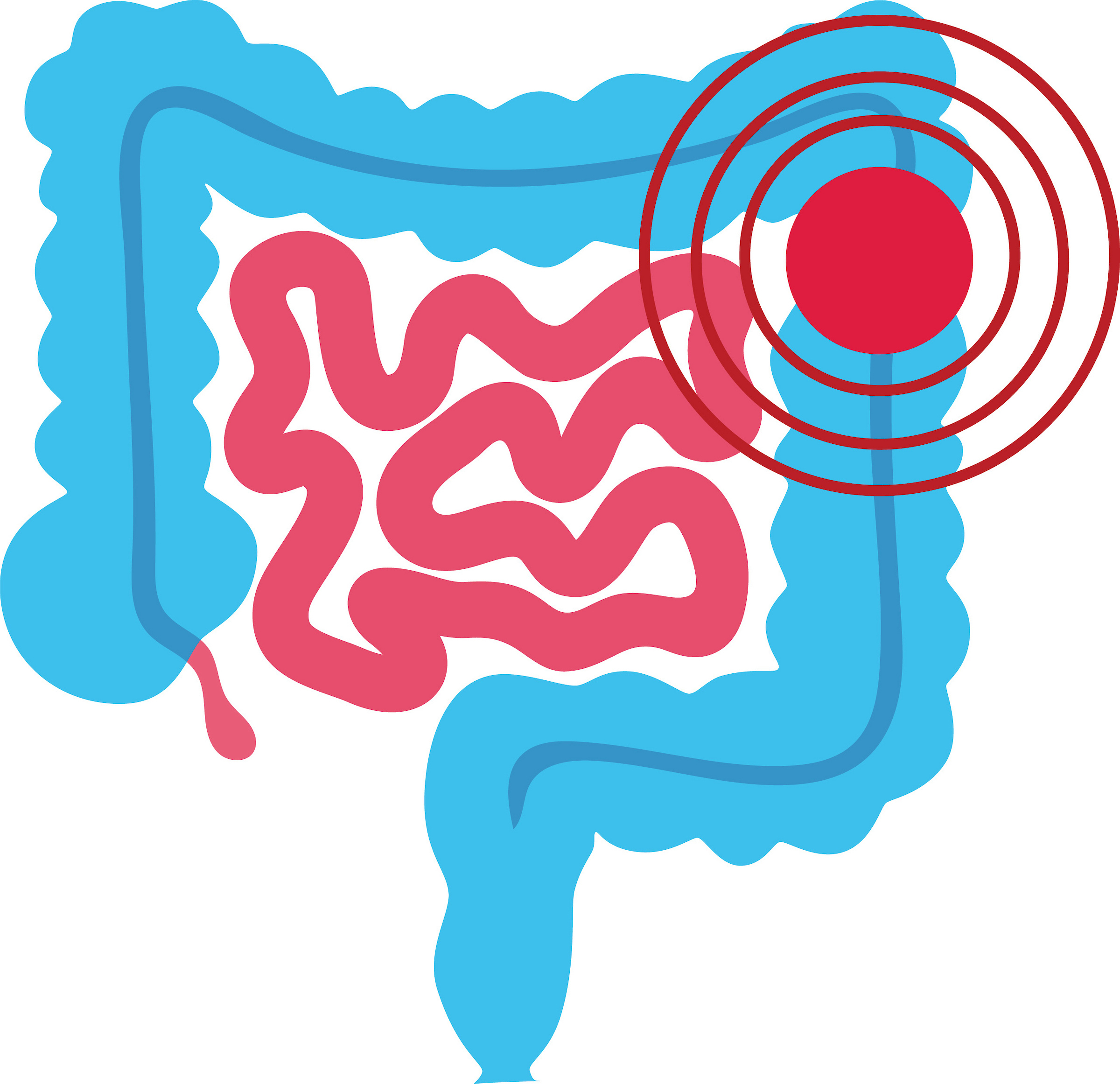 A link between bacterial infection and colorectal cancer: Study ...