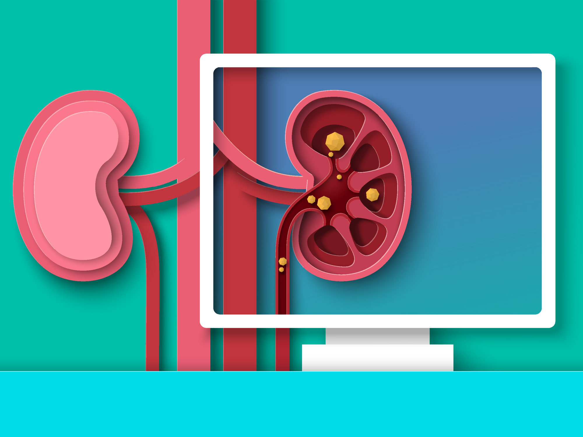 Kidney stone grant to create research resource for adults and children ...