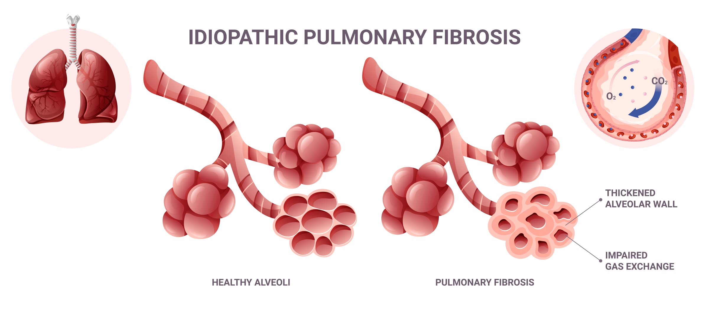 Pulmonary Fibrosis Nano Drug Delivery Breakthrough Reveals New
