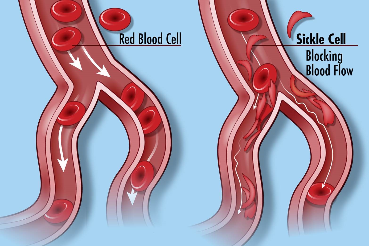 International trial introduces another curative option for sickle cell ...